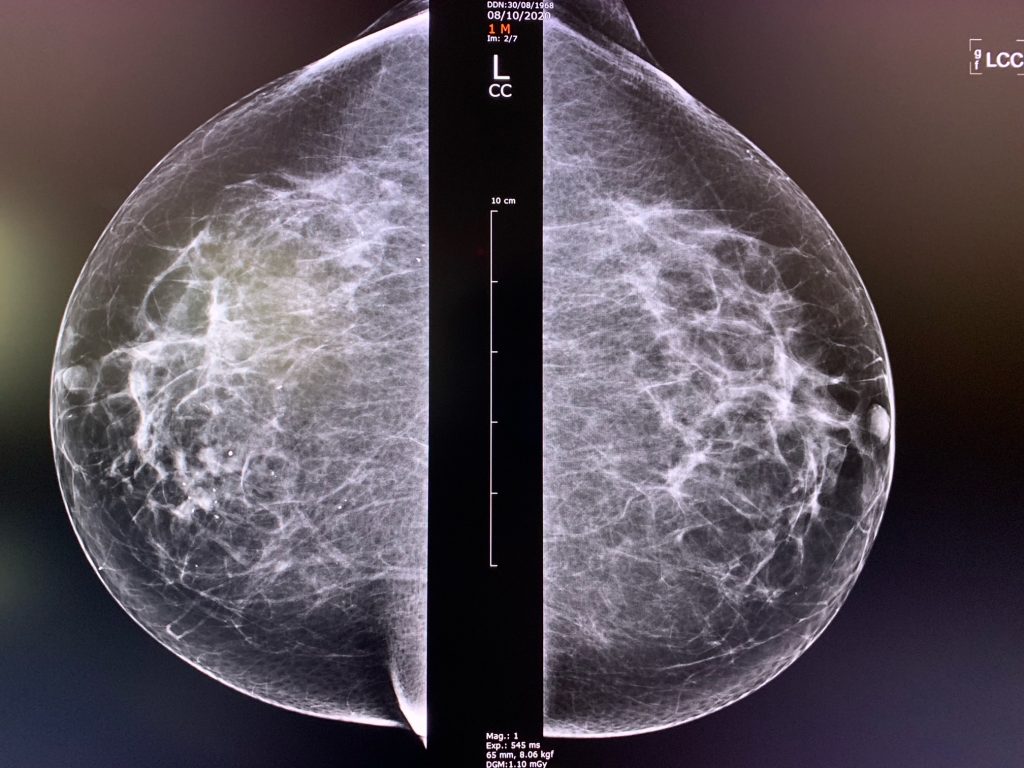 Case of the week (week 51, 2020) - MammoScreen®