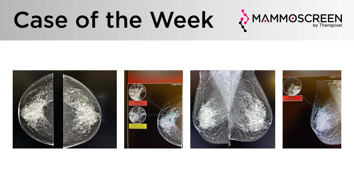 Case of the week (week 10, 2021) - MammoScreen®