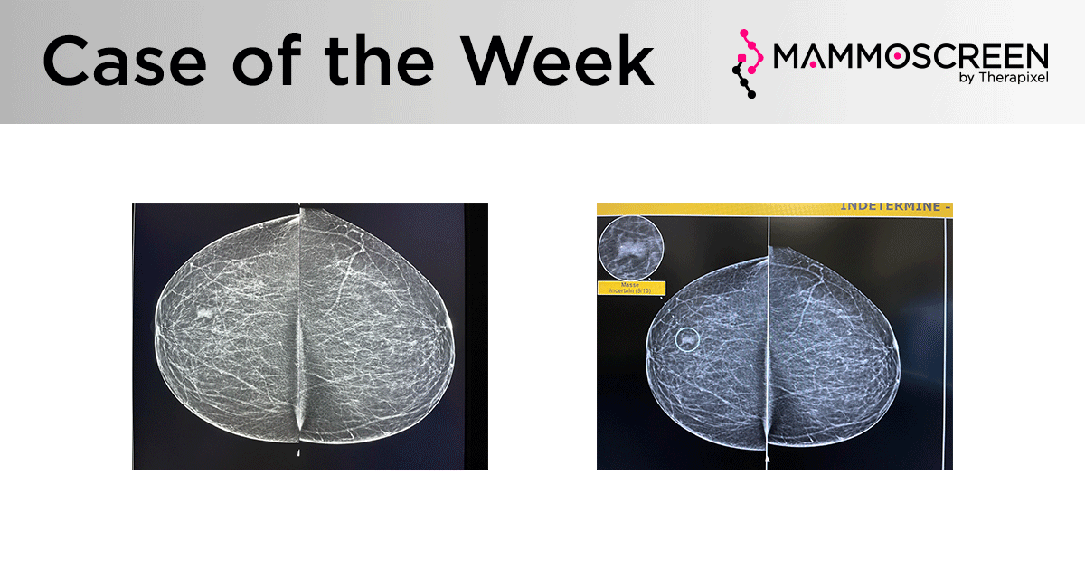 Case of the week (week 11, 2021) - MammoScreen®