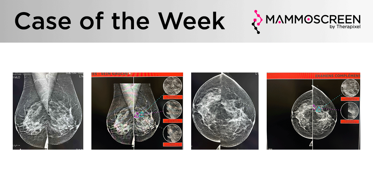 Case of the week (week 13, 2021) - MammoScreen®