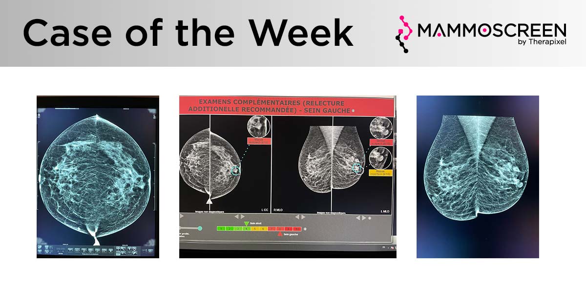 Case of the week (week 9, 2022) - MammoScreen®