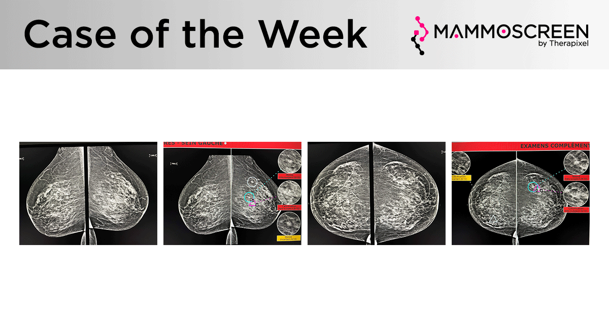 Case of the week (week 47, 2022) - MammoScreen®