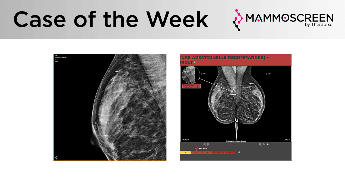 Case of the week (week 17, 2021) - MammoScreen®