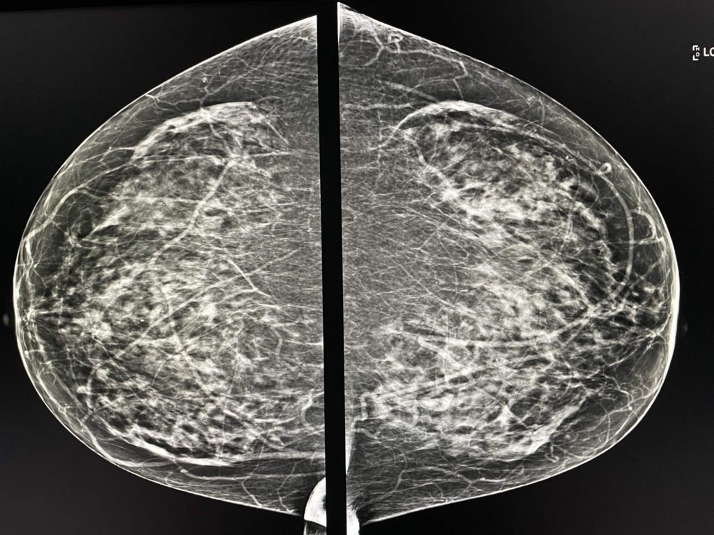 Case of the week (week 47, 2022) - MammoScreen®