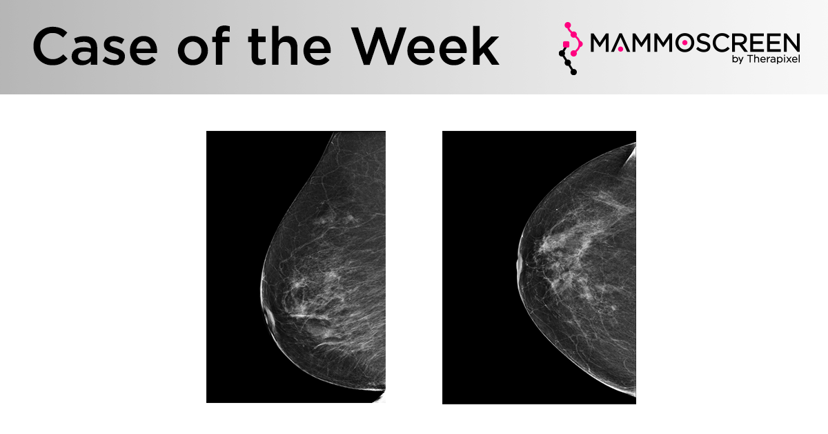 Case of the week (week 51, 2021) - MammoScreen®