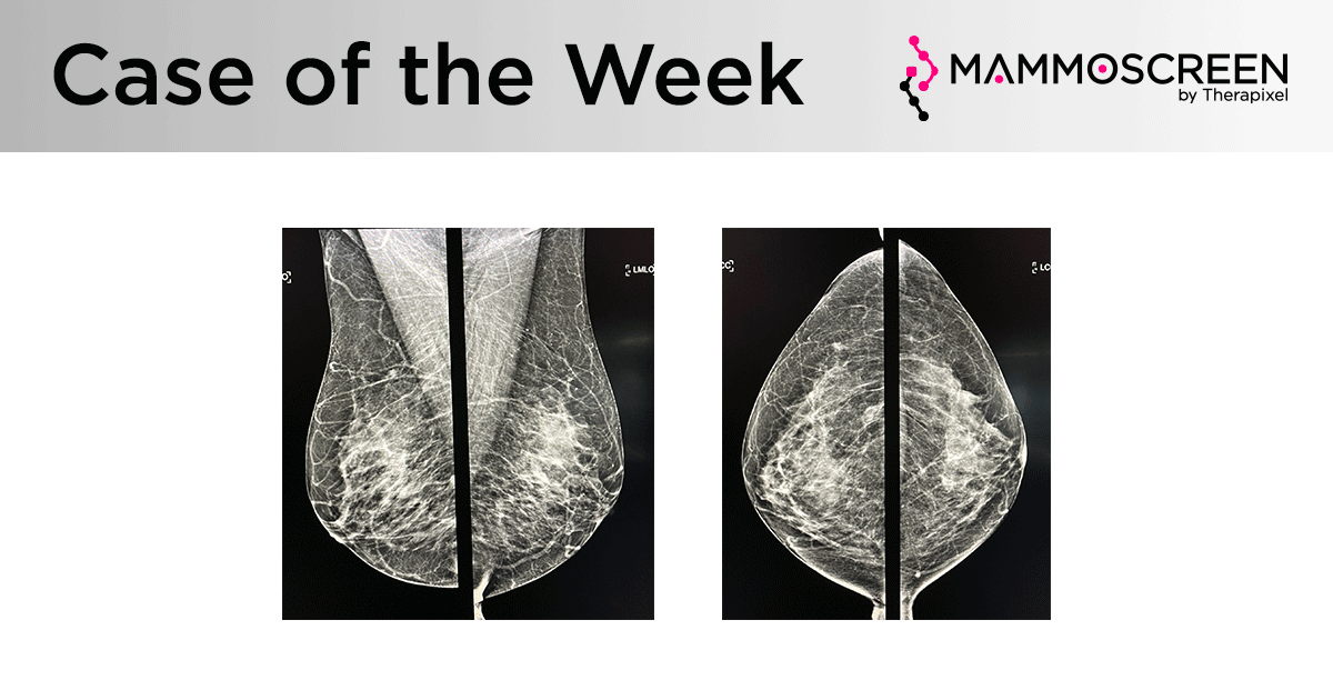Case of the week (week 20, 2021) - MammoScreen®