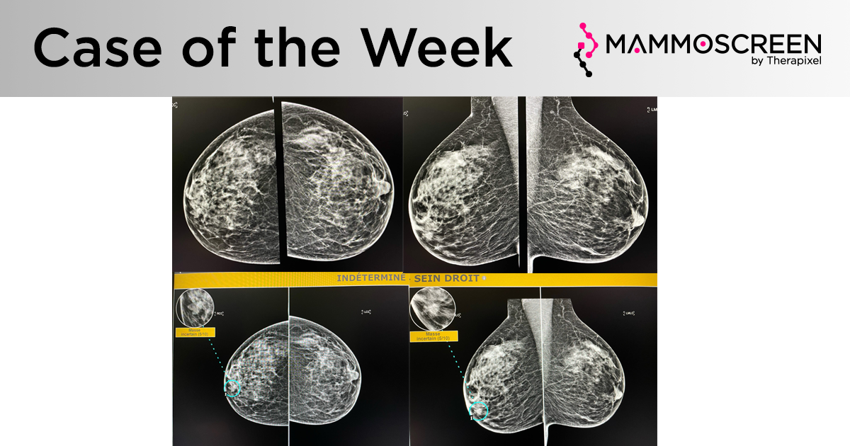 Case of the week (week 27, 2021) - MammoScreen®