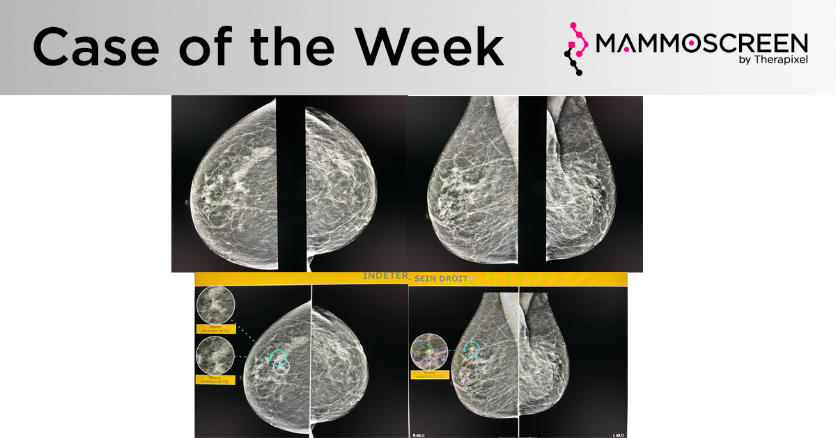 Case of the week (week 33, 2023) - MammoScreen®