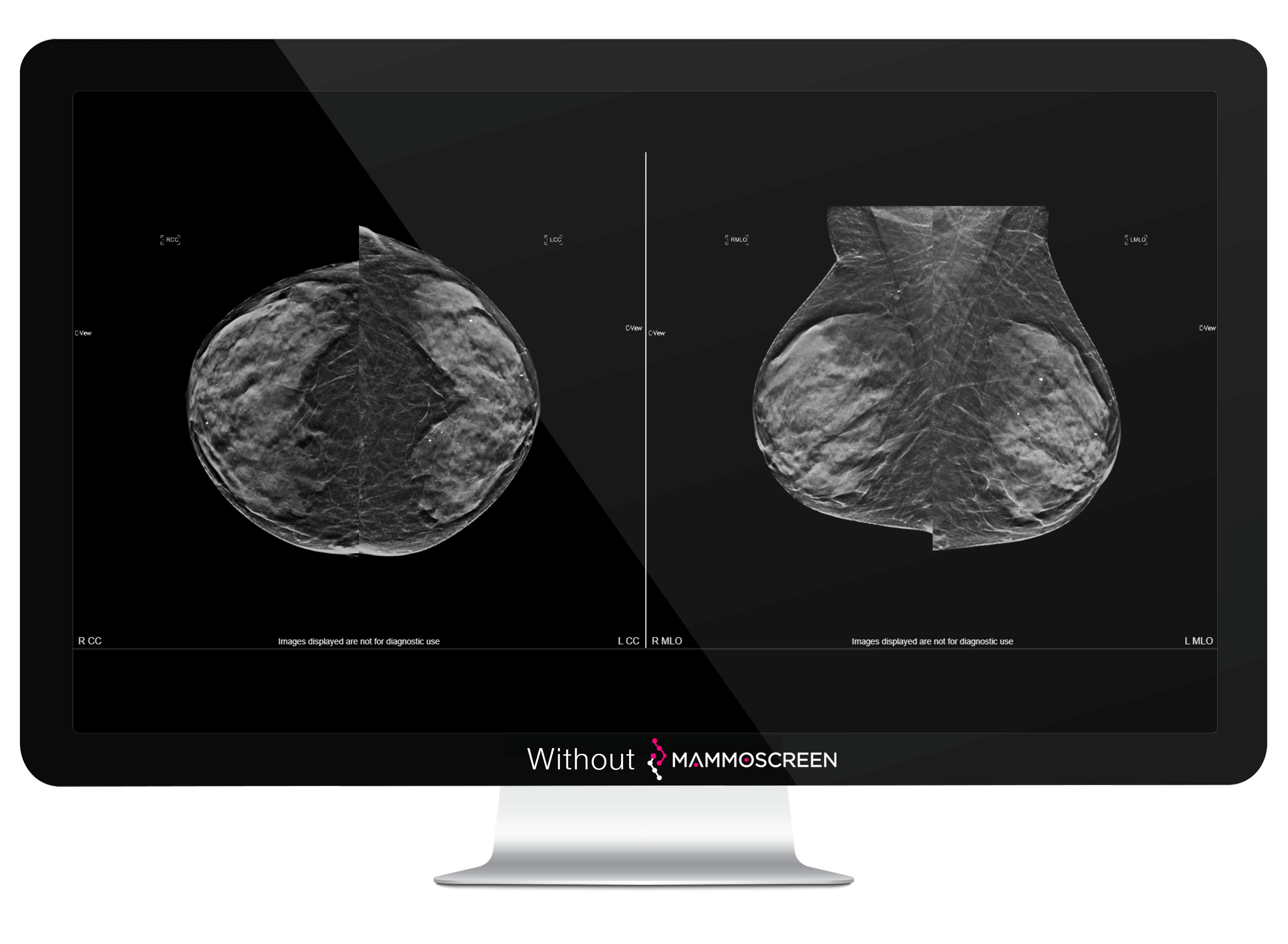 How it works - MammoScreen®