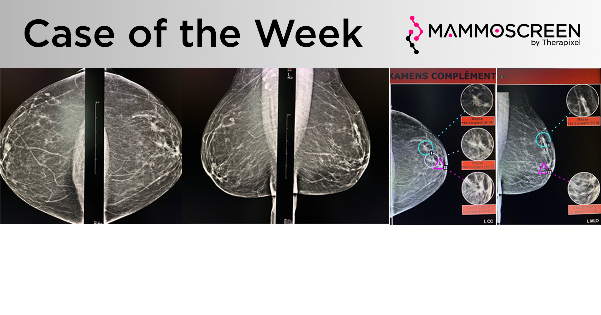 Case of the week (week 36, 2022) - MammoScreen®