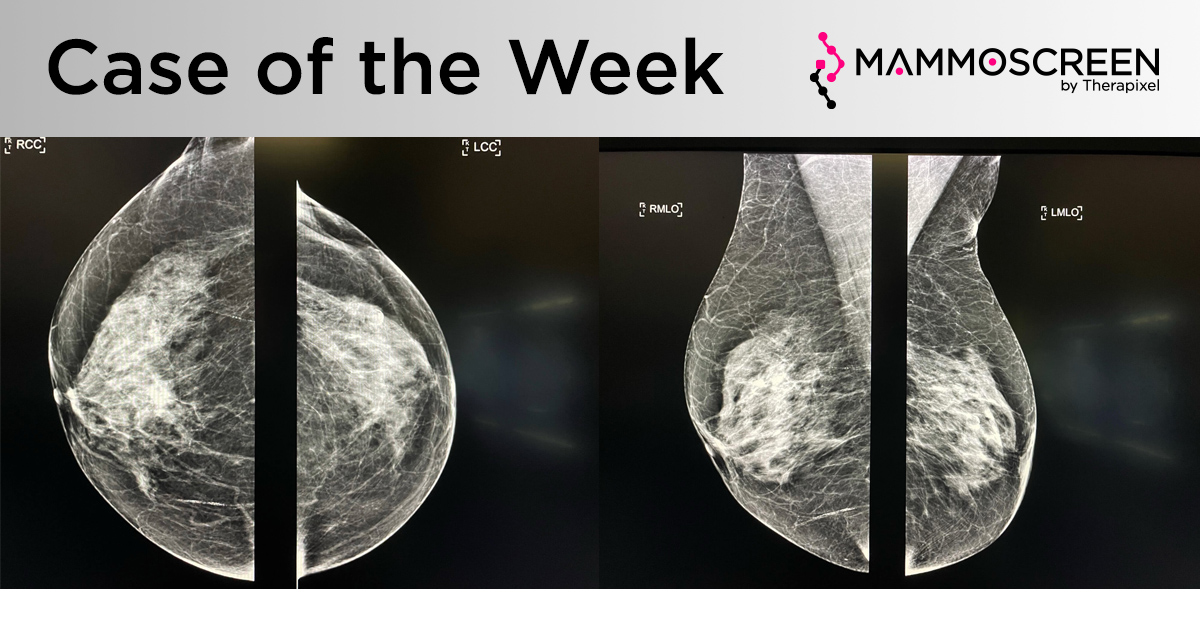 Case of the week (week 37, 2021) - MammoScreen®