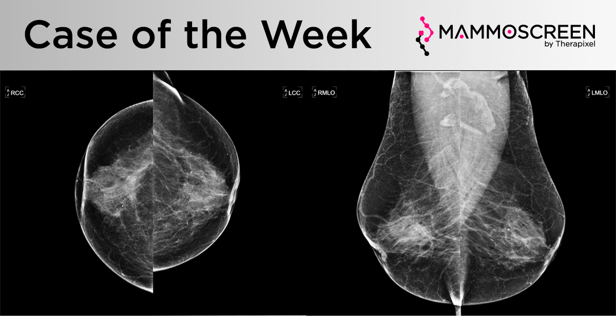 Case of the week (week 40, 2021) - MammoScreen®