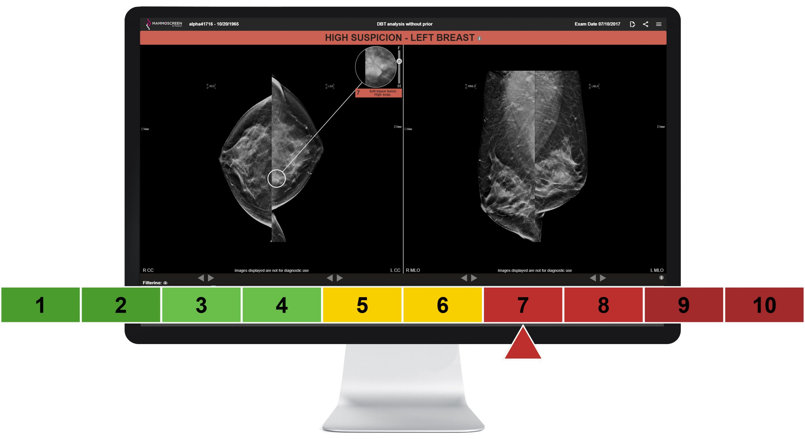 Artificial Intelligence for Breast Cancer Screening - MammoScreen™