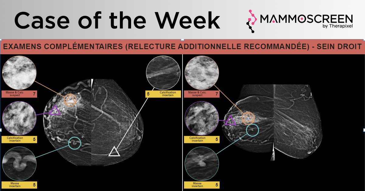 Case of the week (week 50, 2021) - MammoScreen®