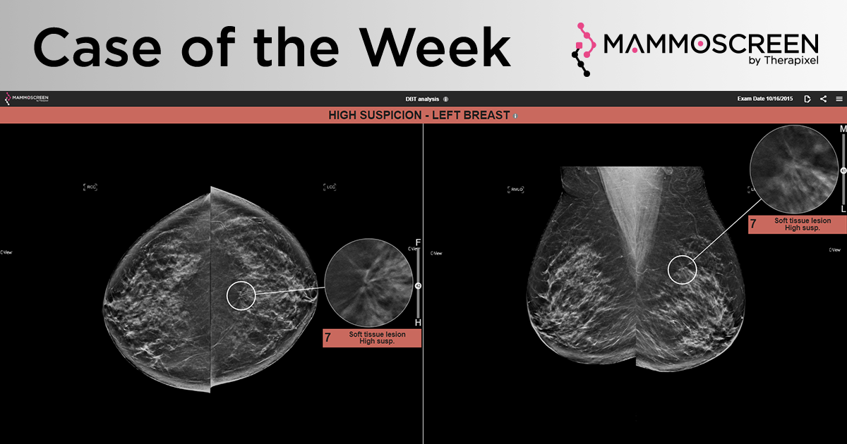 Case of the week (week 12, 2022) - MammoScreen®