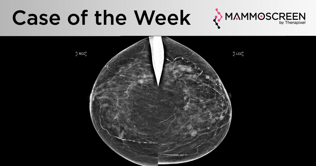 Case of the week (week 38, 2022) - MammoScreen®
