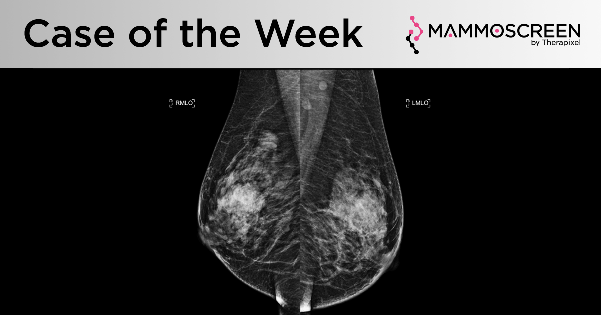 Case of the week (week 43, 2022) - MammoScreen®