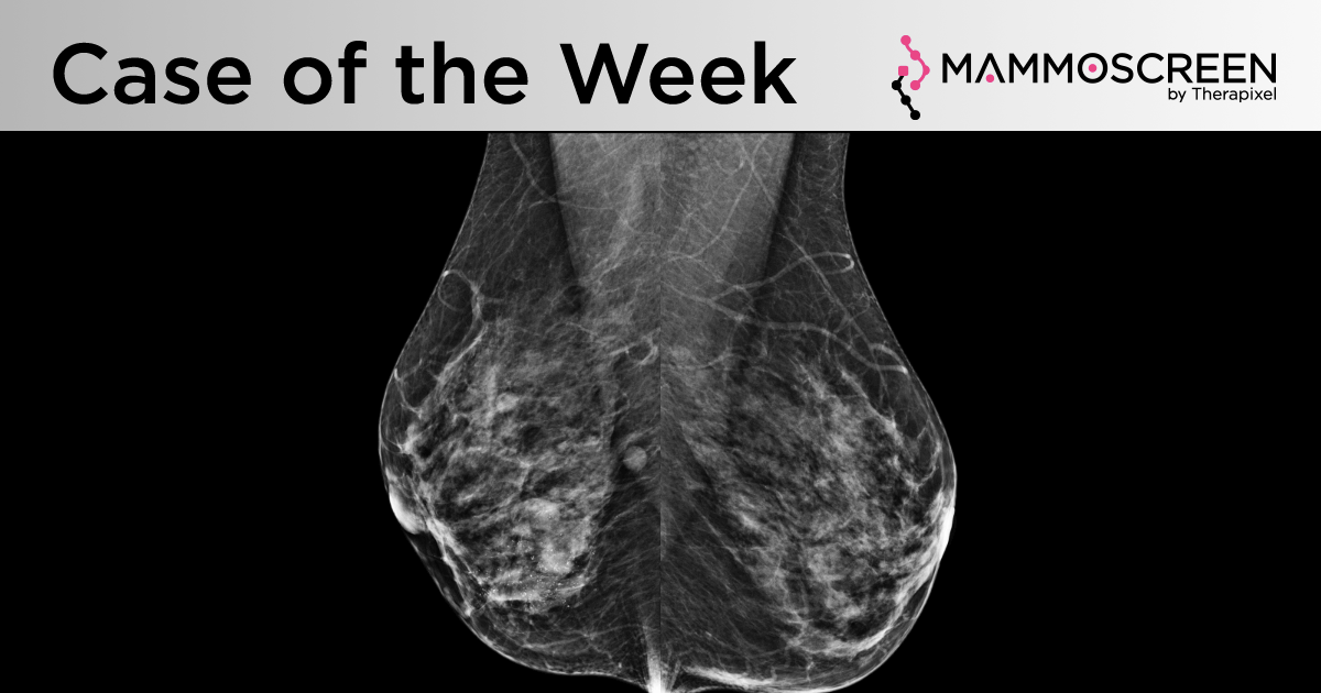 Case of the week (week 44, 2022) - MammoScreen®