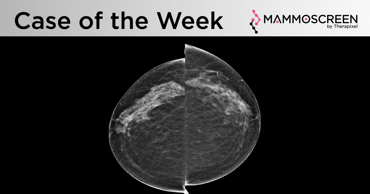 Case of the week (week 45, 2022) - MammoScreen®