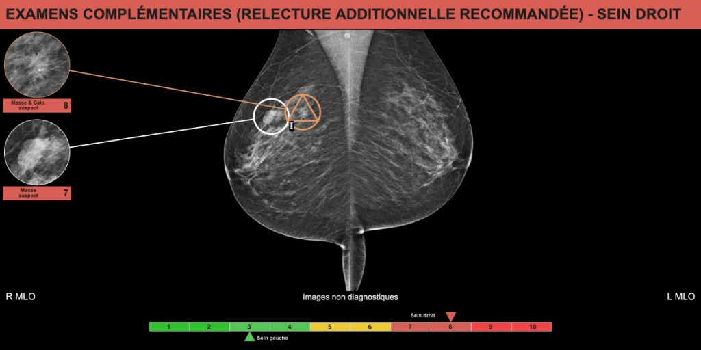 Case of the week (week 45, 2022) - MammoScreen®