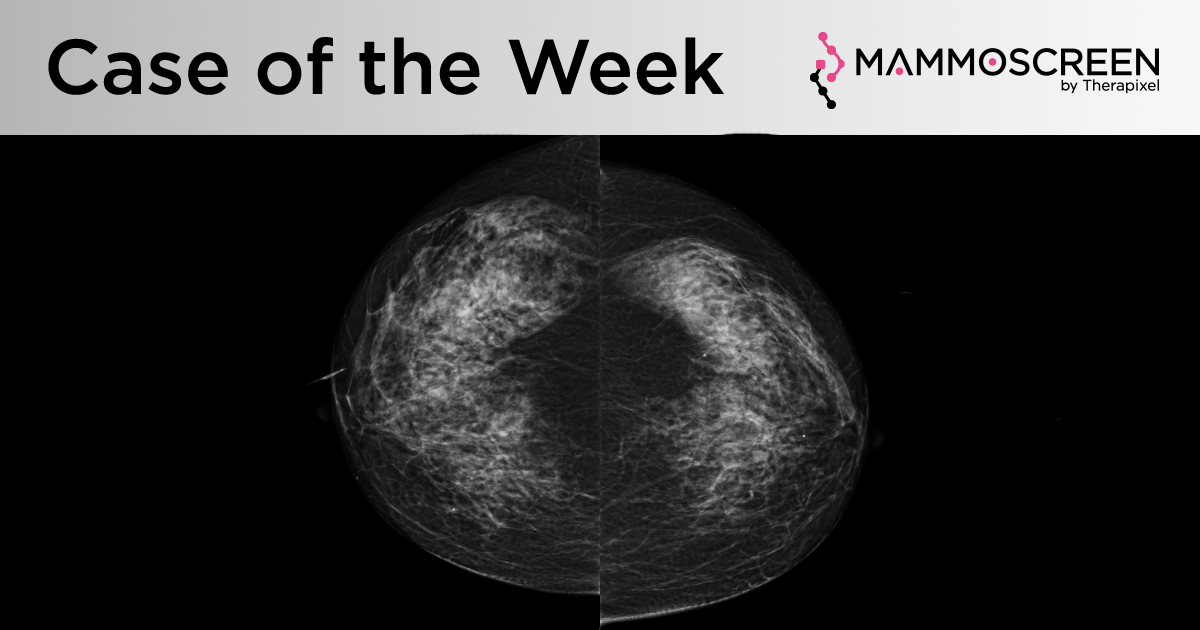 Case of the week (week 51, 2022) - MammoScreen®