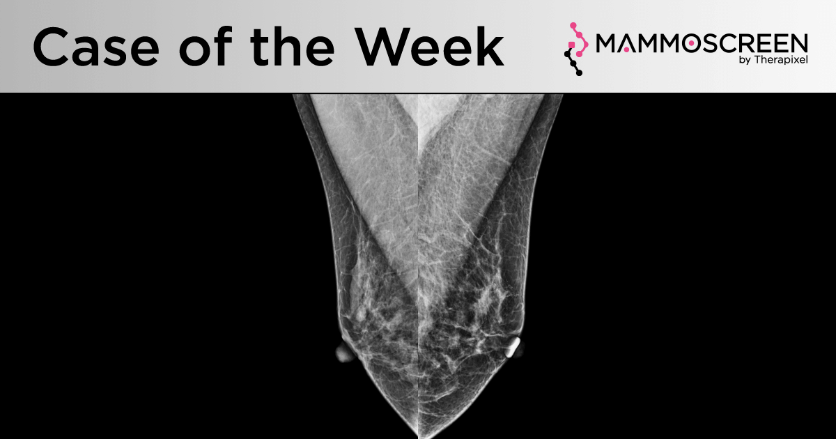 Case of the week (week 43, 2023) - MammoScreen®