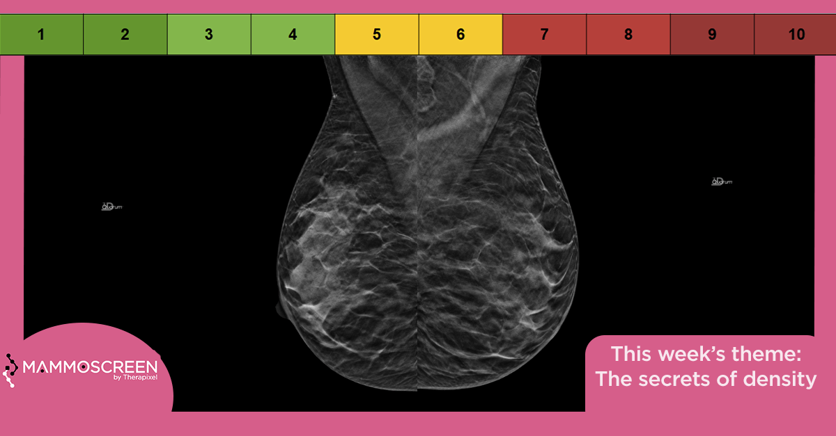Case of the week (week 36, 2024) - MammoScreen®